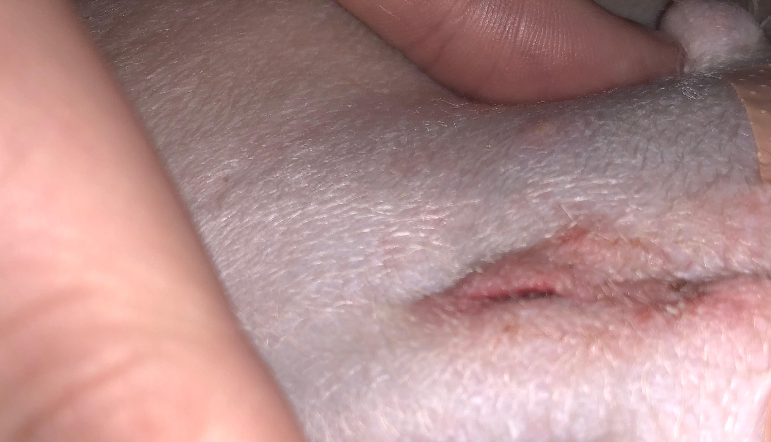 Dog spay incision bleeding, swollen, and licking. Is this normal? | Petco